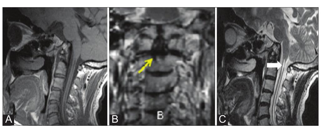 (a-c): odontoid aplasia: sagittal t1w (a) and coronal (b)