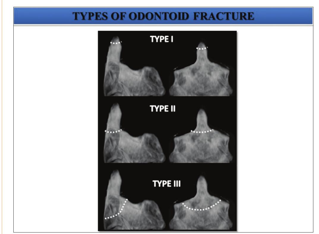Anderson and d’alonzo classification of three types of
