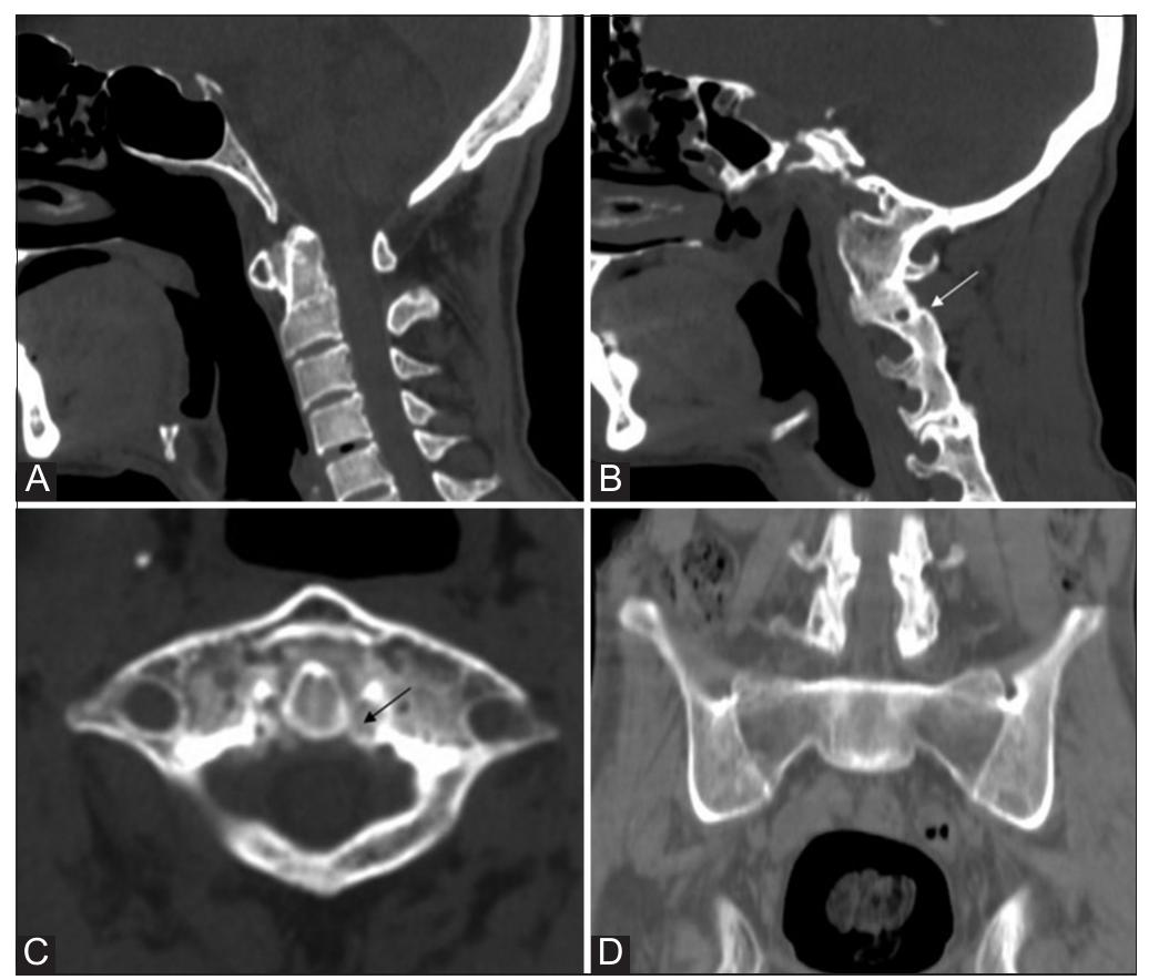 (a-d): ankylosing spondylitis: reformatted sagittal ct (a