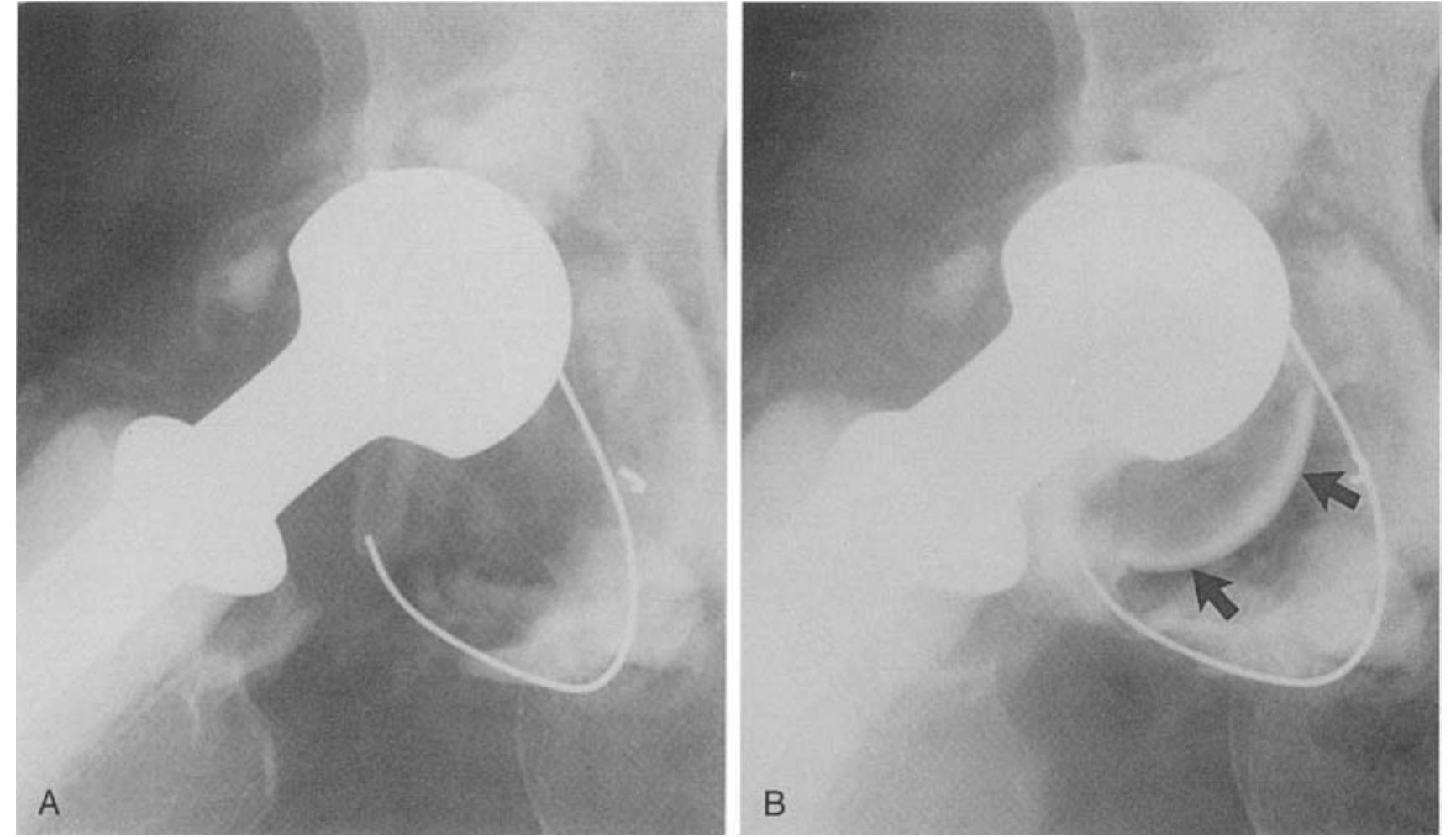 A, scout radiograph. cemented acetabular component showing