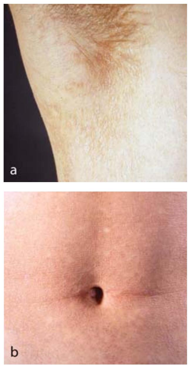 Figure 1 - from Confluent and reticulated papillomatosis