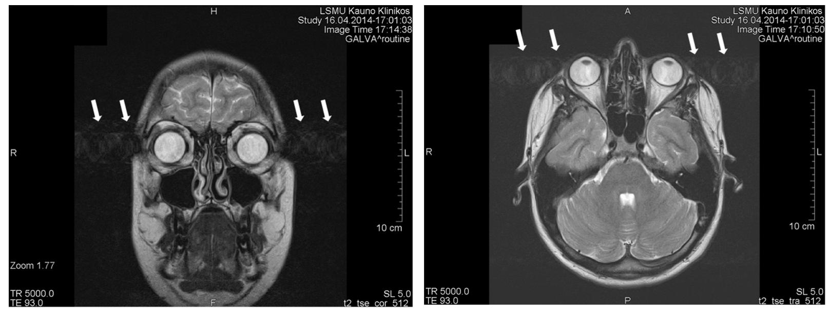 A) mri coronal projection a b) mrt axial projection fig. 2.