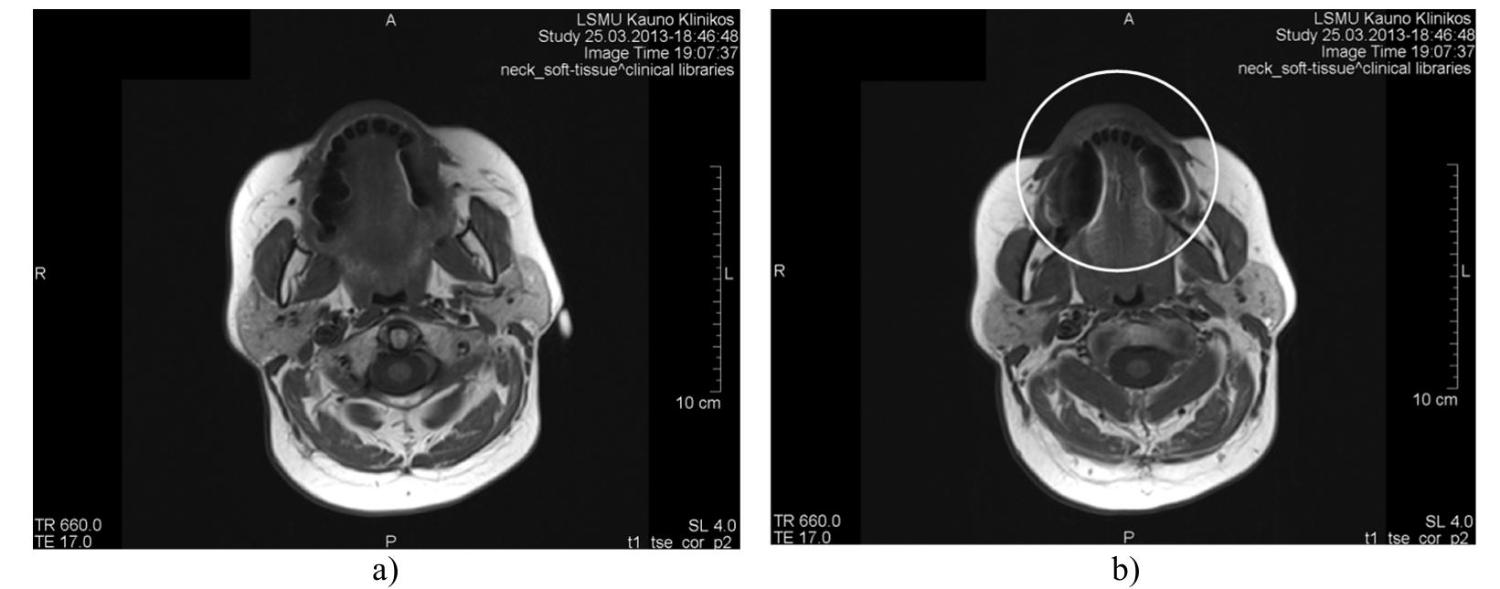 Mri axial projections. numerous metal artifacts are visible