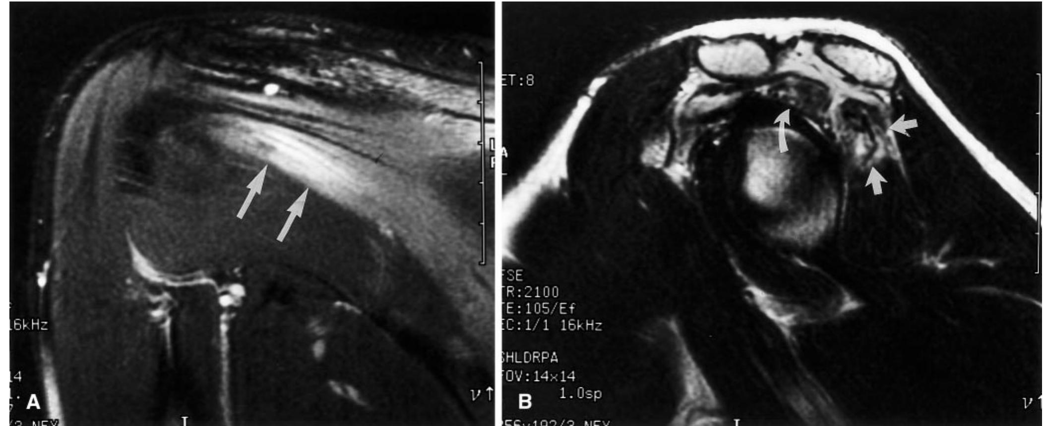 Seen on t1-weighted spin-ec scles of the rotator cuff