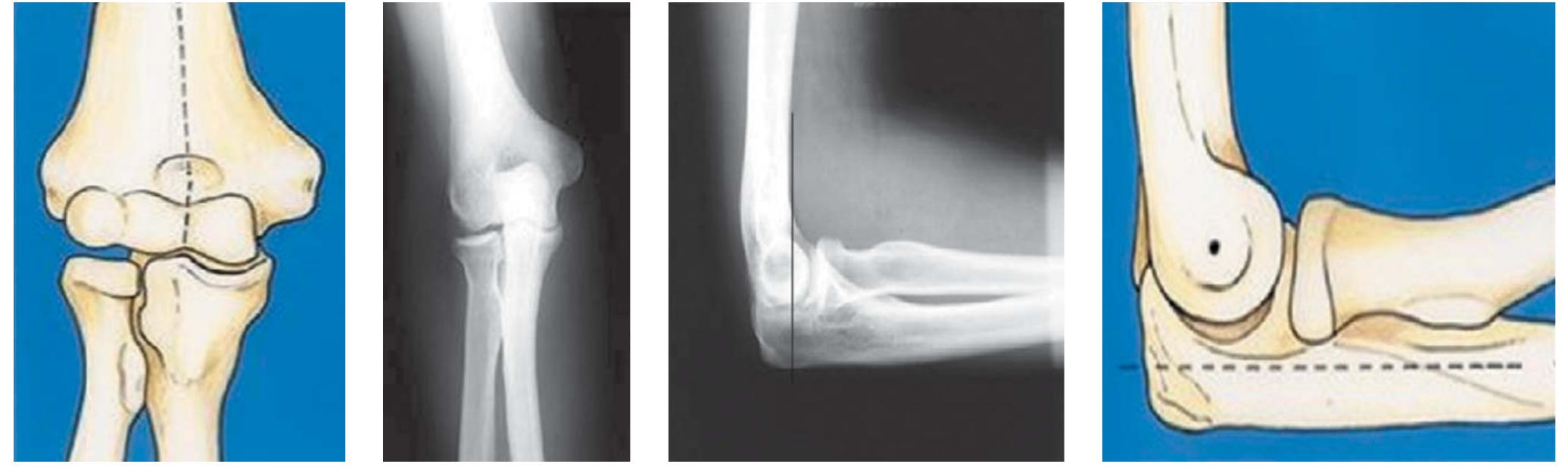 Anatomy of the distal part of the humerus. ‘note that the