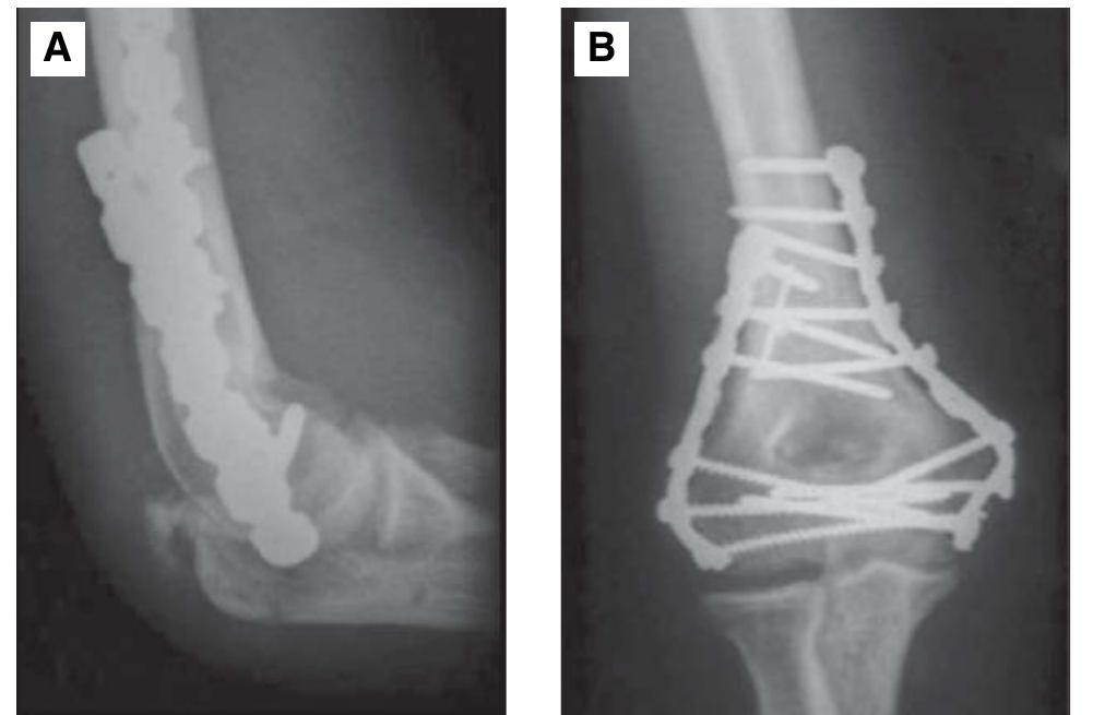Figure 8 - Intercondylar humerus fractures: current concepts