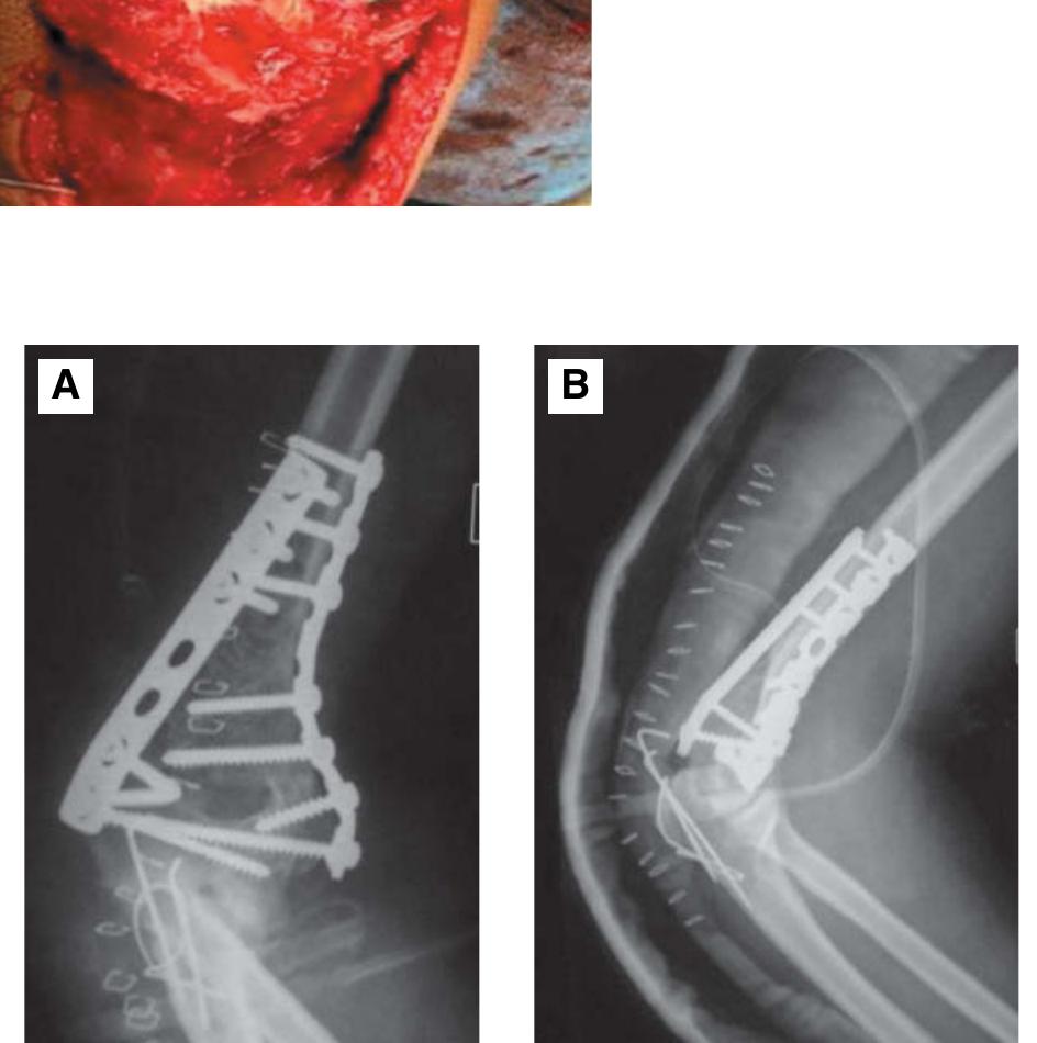 Figure 14 - Intercondylar humerus fractures: current
