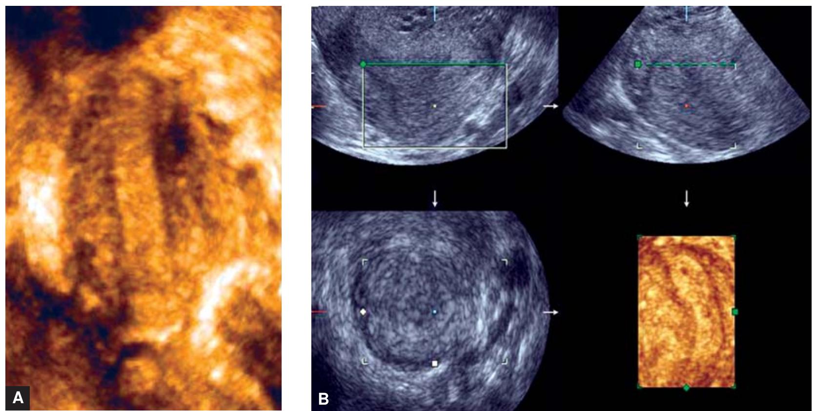 S 10a and b: elongated narrow uterus with no cornual angle: