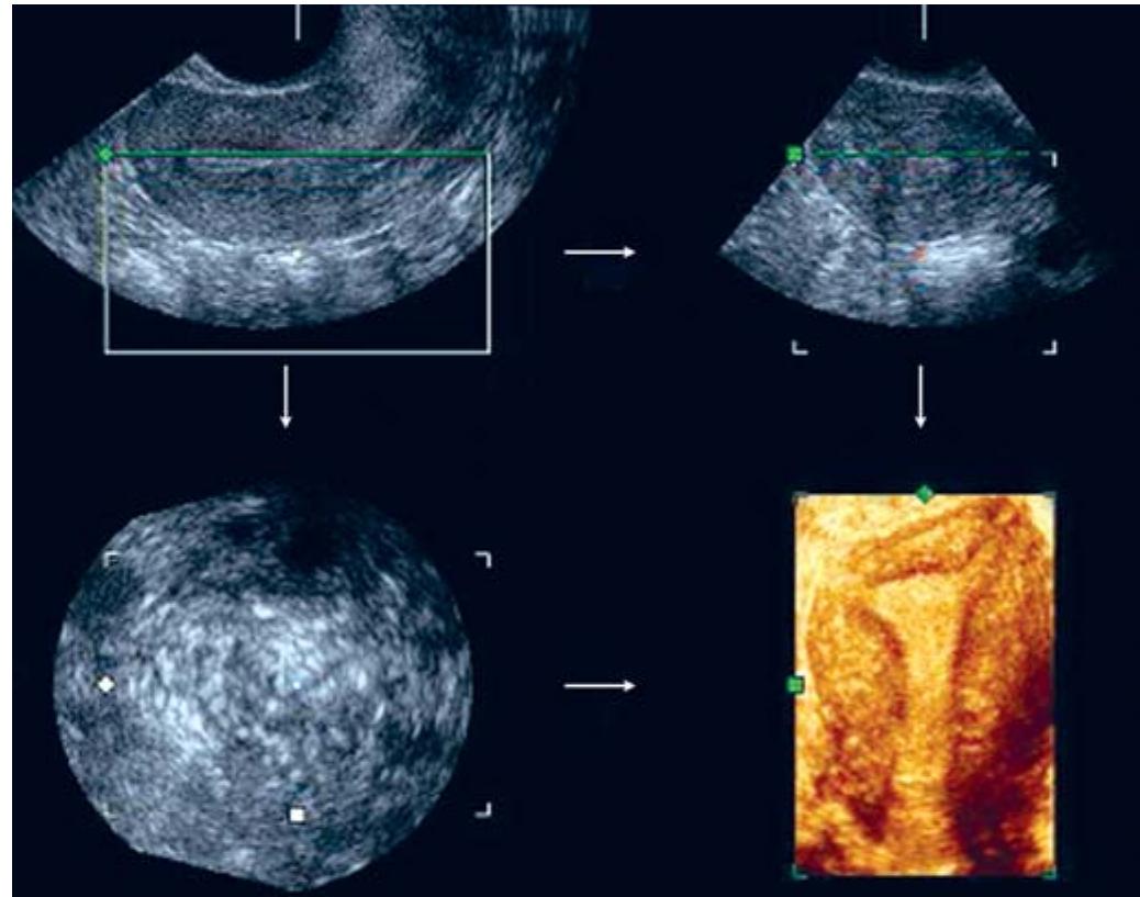 3d rendered image showing a subseptate uterus with an