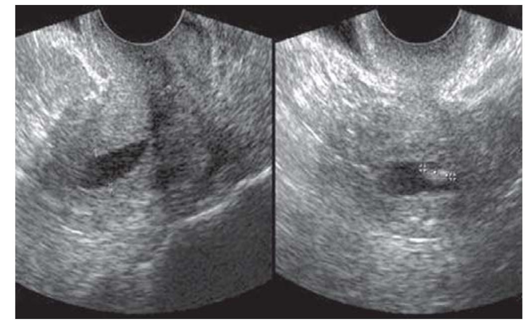 A: transvaginal scan showing an endometrial fluid collection