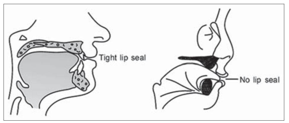 Etiology of tongue thrust habit - retained infantile