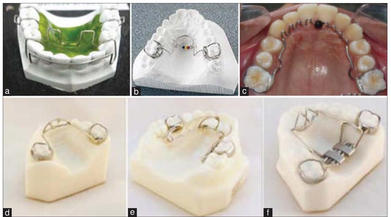 (a-f) different tongue thrusting habit breaking hybrid