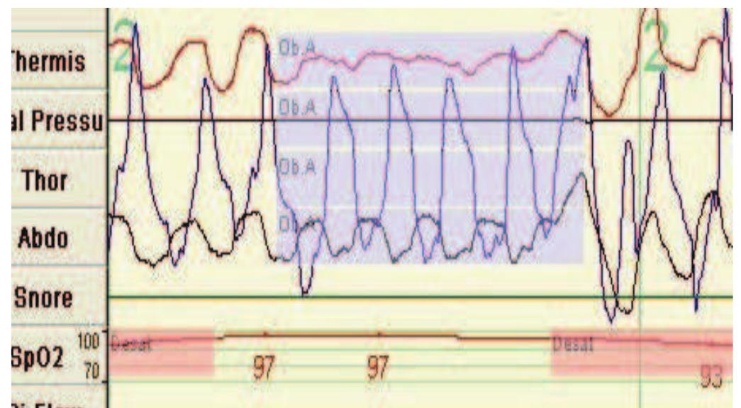 Thermistor, nasal pressure, thoracic and abdominal signals