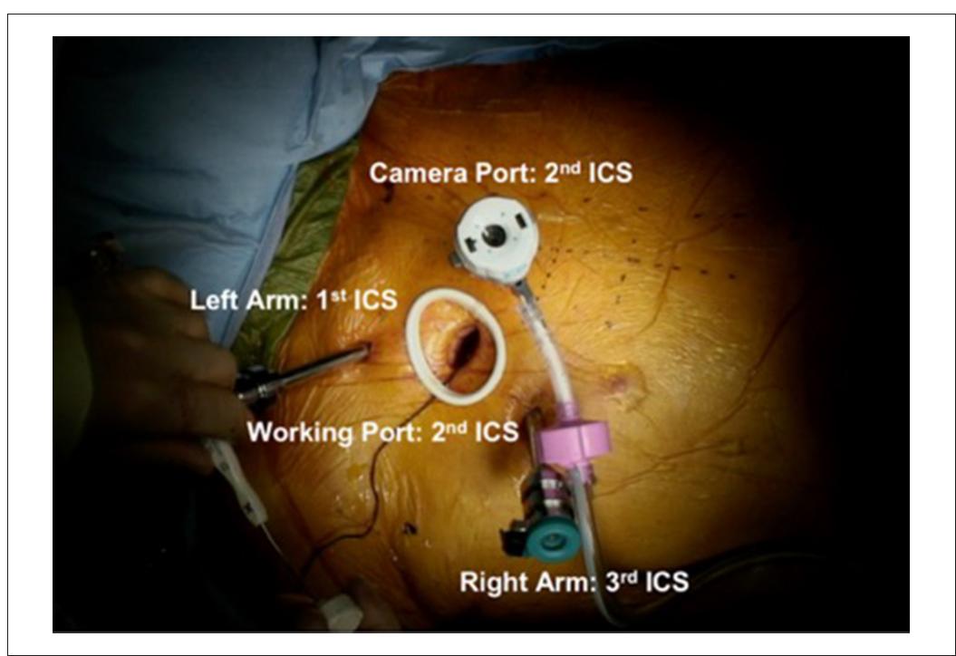 Port placement for robotic aortic valve surgery.