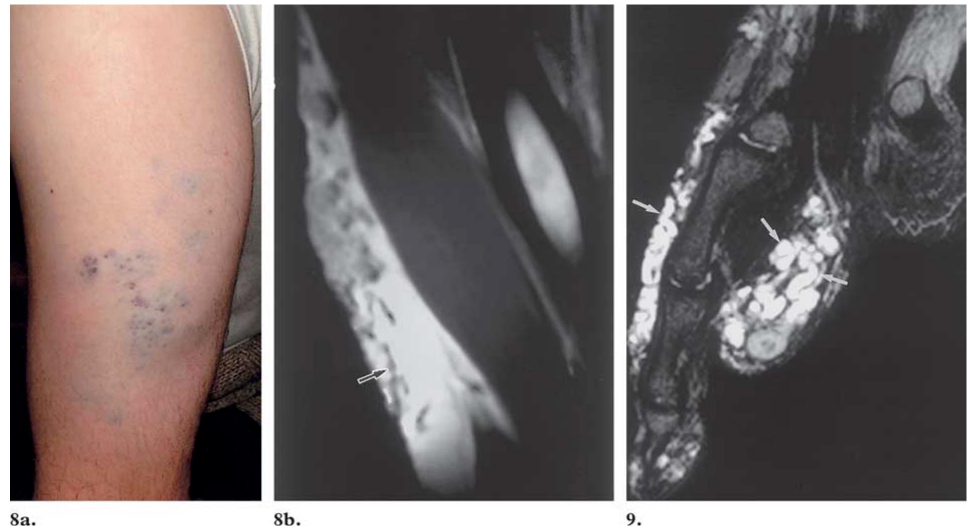 S 8,9. (8) venous malformation of the left arm. (a) clinical
