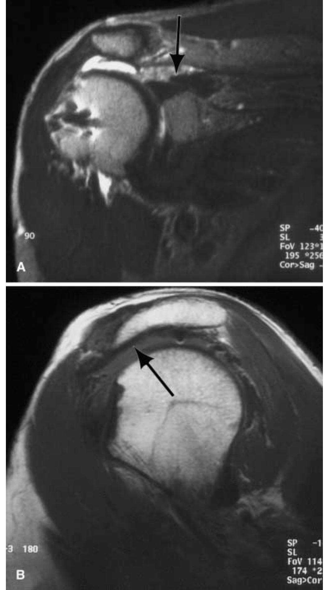 A, b recurrent rotator cuff tear. a coronal oblique t2-