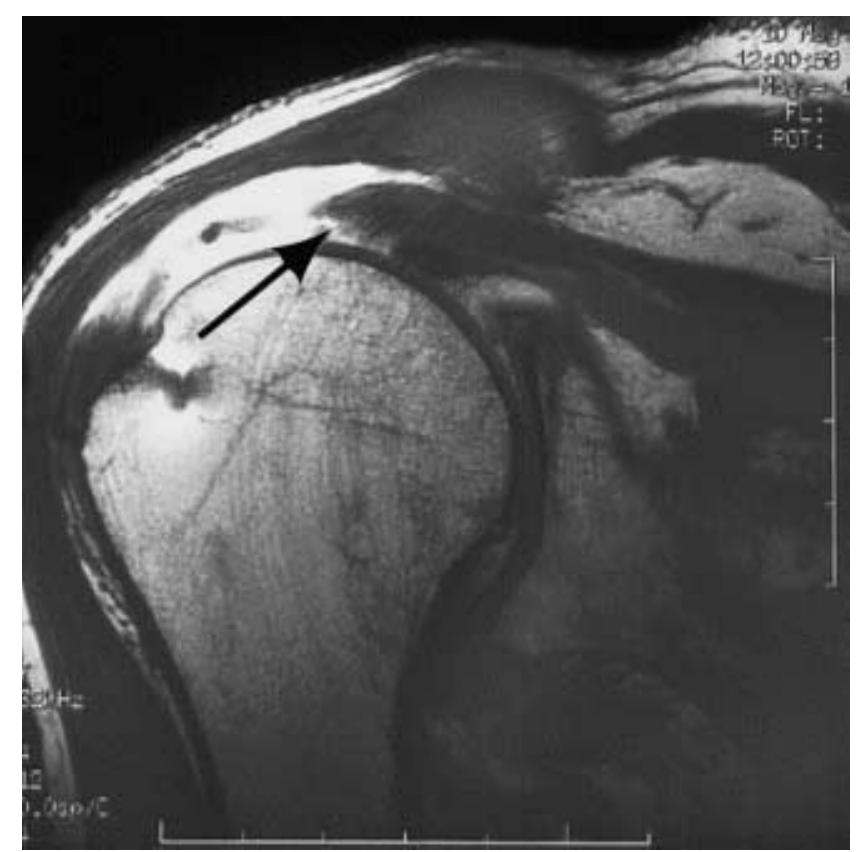 Figure 10 - from MRI of the postoperative shoulder