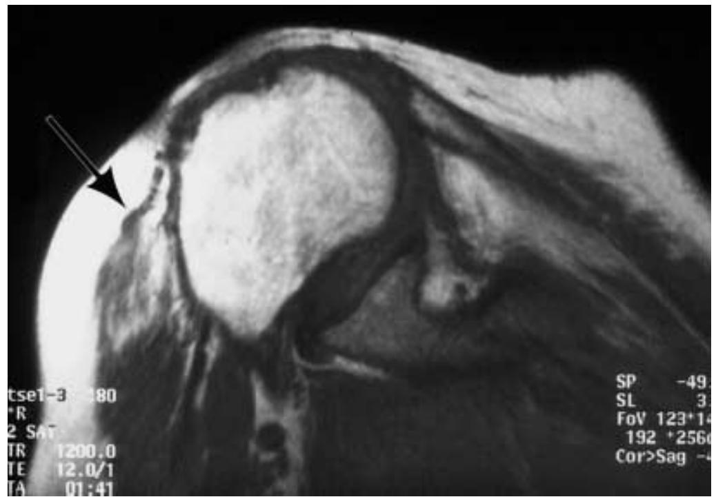 Deltoid detachment. coronal oblique proton density weighted