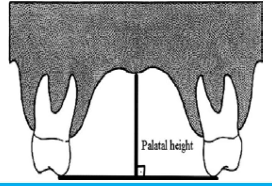 Measurement of palatal height/depth of upper first molars