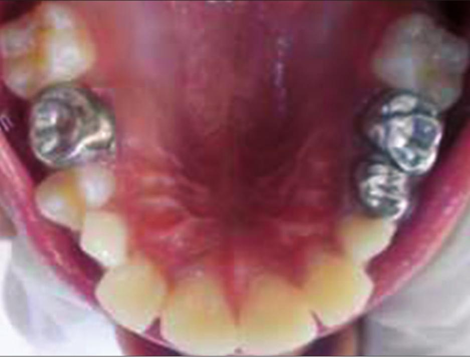 Intra oral photograph showing complete eruption of 14,