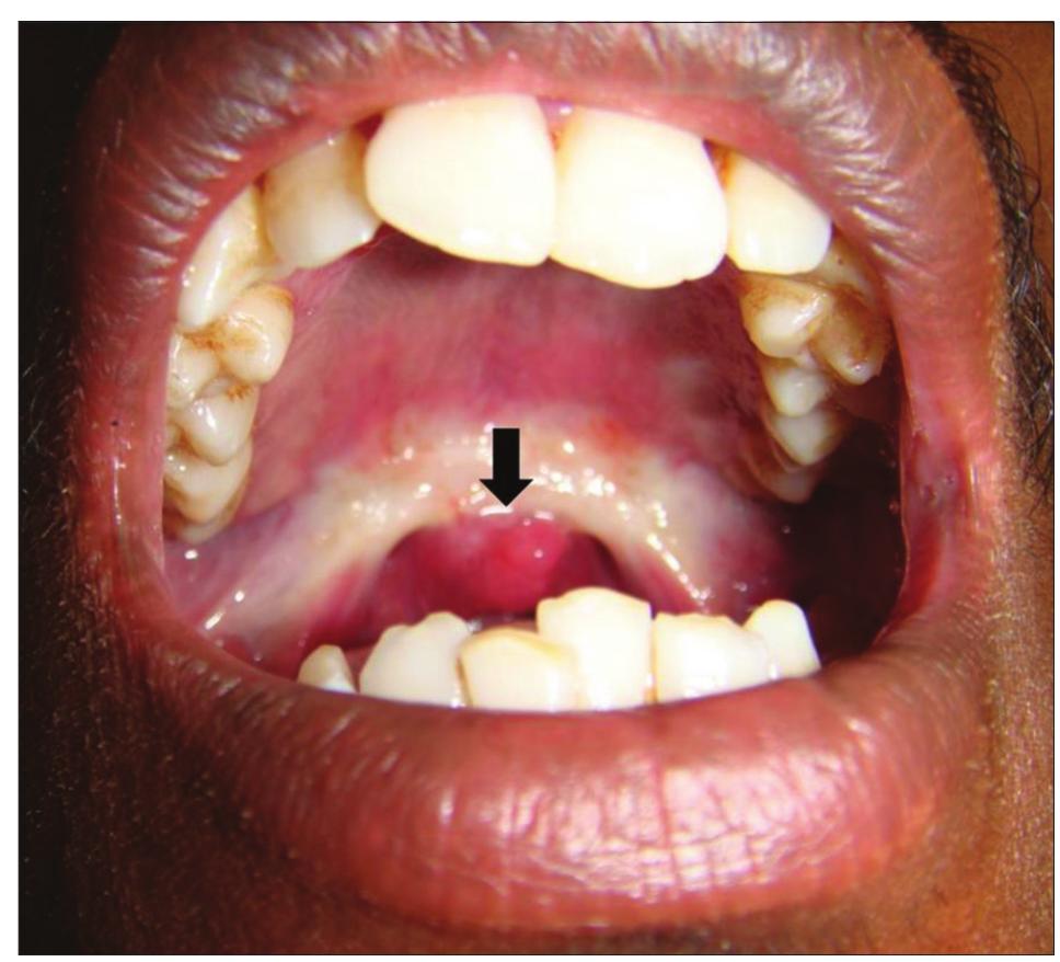 Oral Submucous Fibrosis Blanching