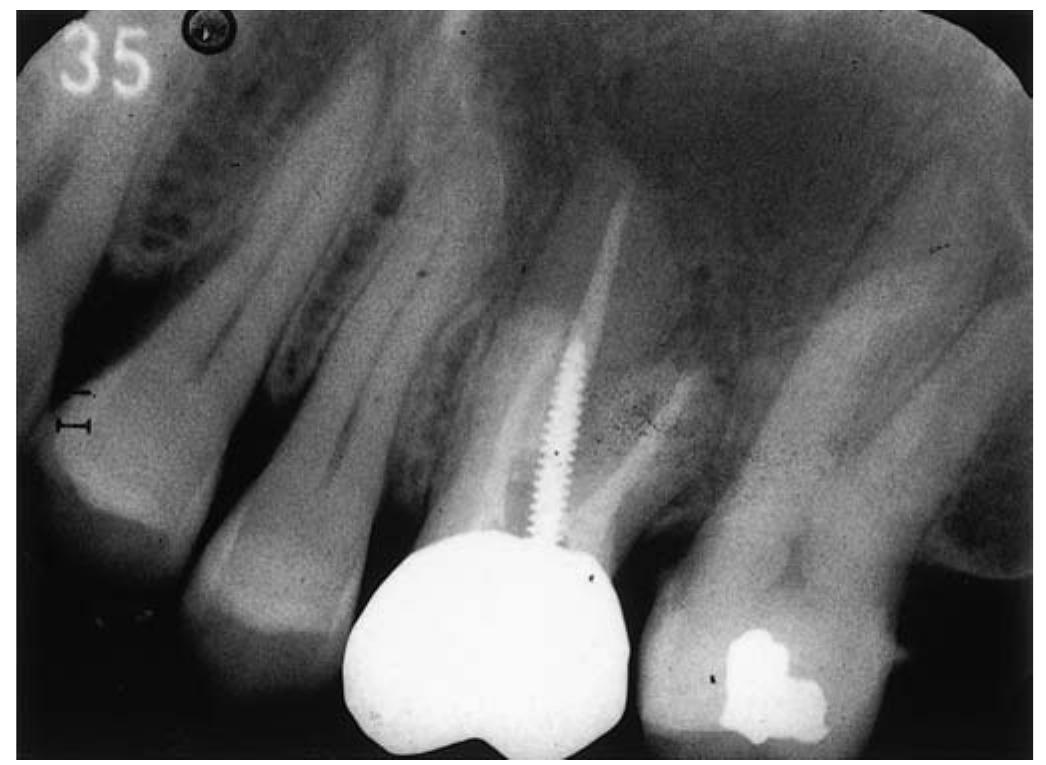 Intraoral radiograph showing the periodontal space of the