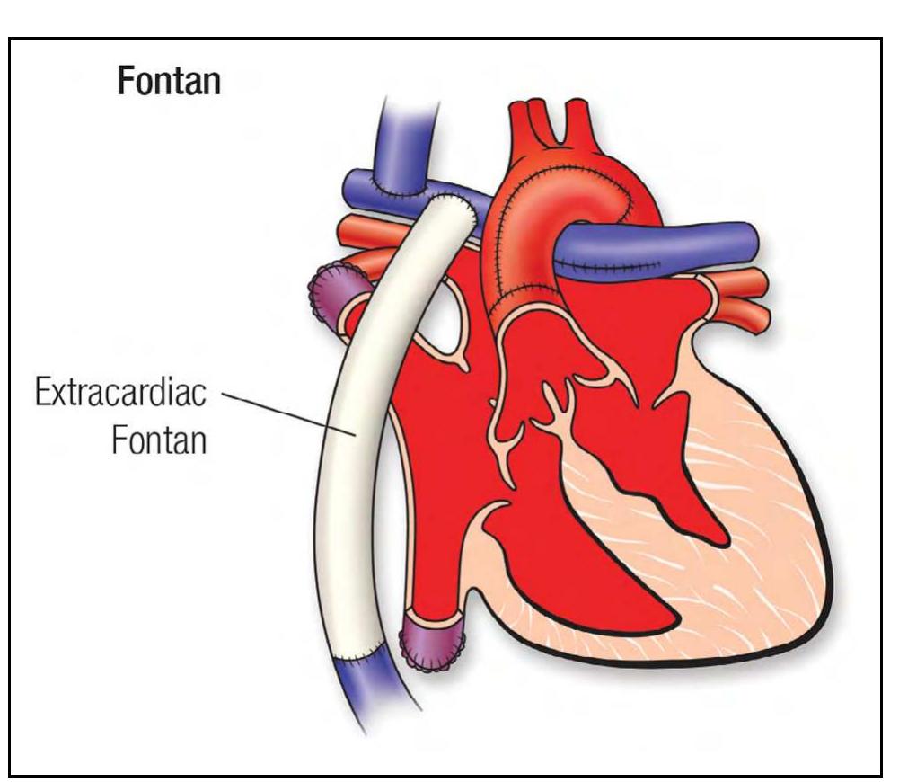 Stage iii fontan single ventricle palliation with an