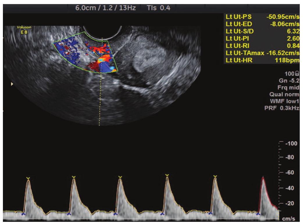 Color doppler and spectral image uterus showing the uterine