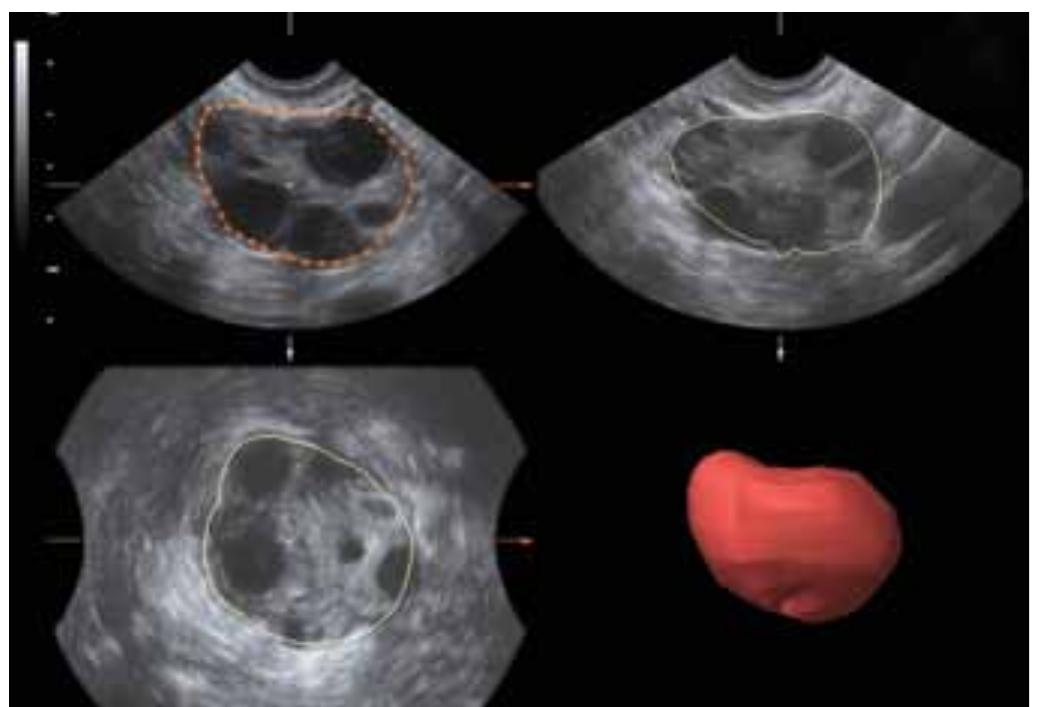 3d ultrasound with volume calculation of ovary by vocal