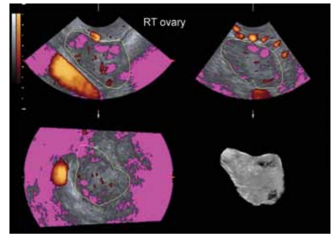 Three-dimensional ultrasound of ovary with volume calculated