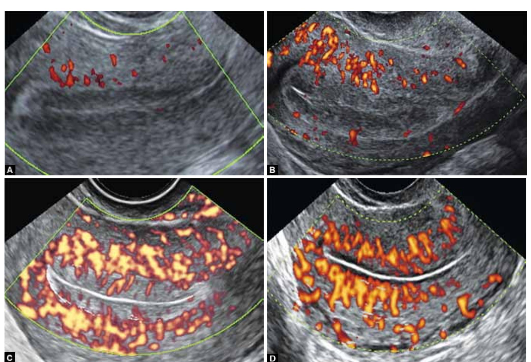 S 13a to d: zone 1, 2, 3, 4 vascularity seen in endometrium