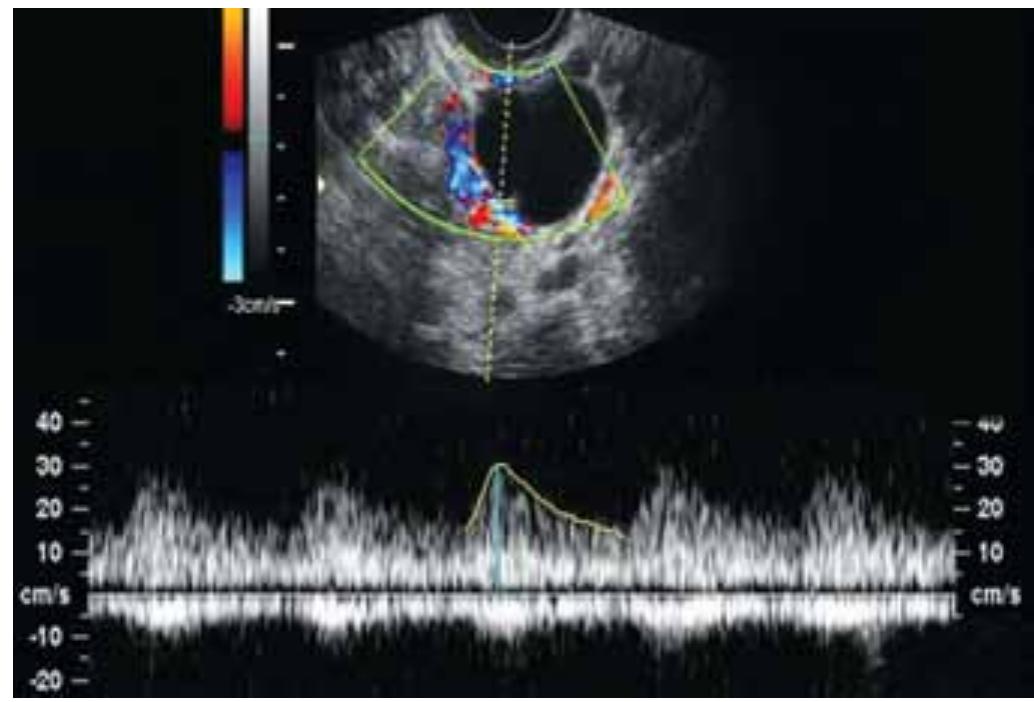 Luf: high resistance flow in luteinized unruptured follicle