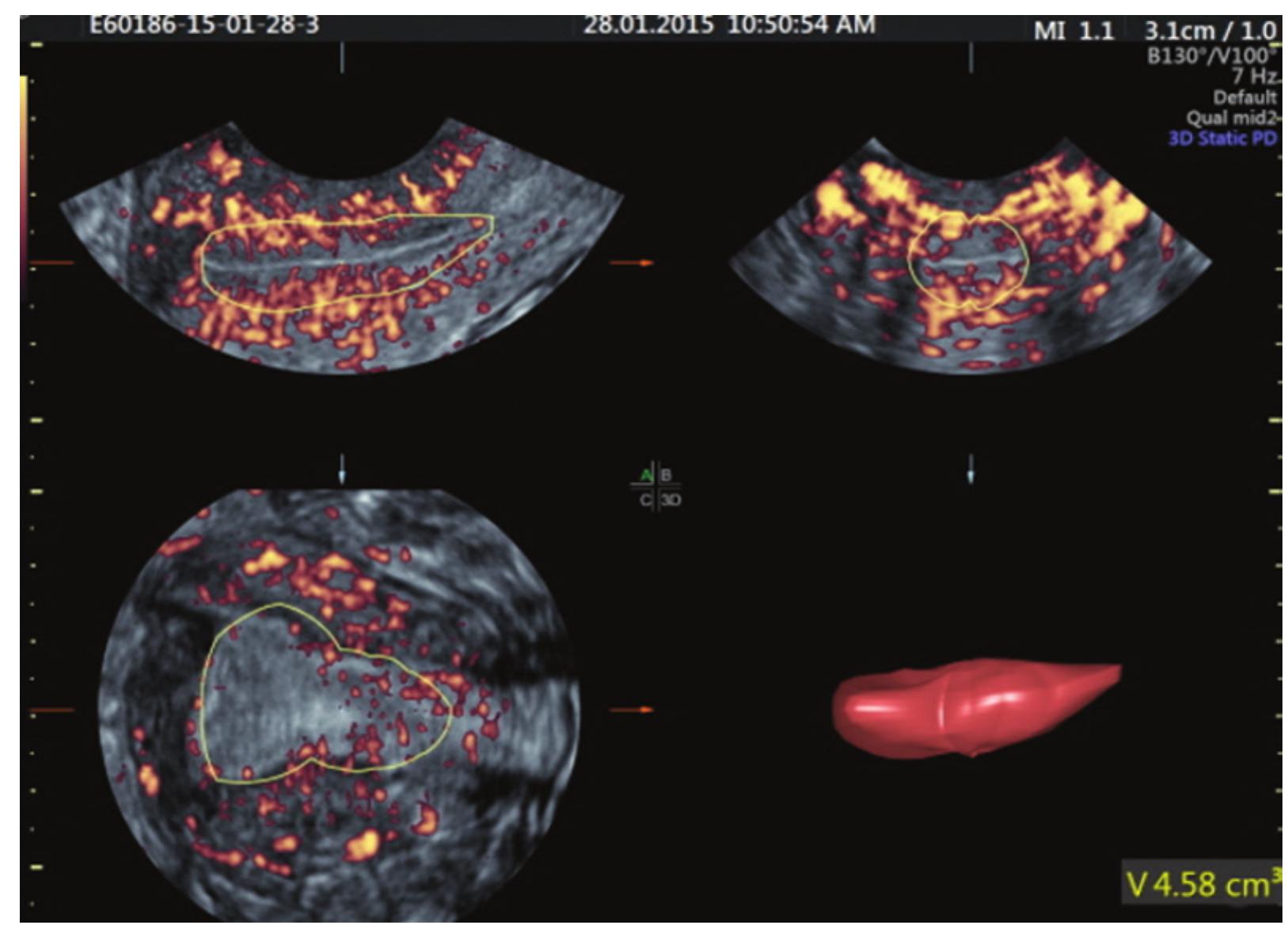 Assessment of endometrial volume by 3d us and vocal.