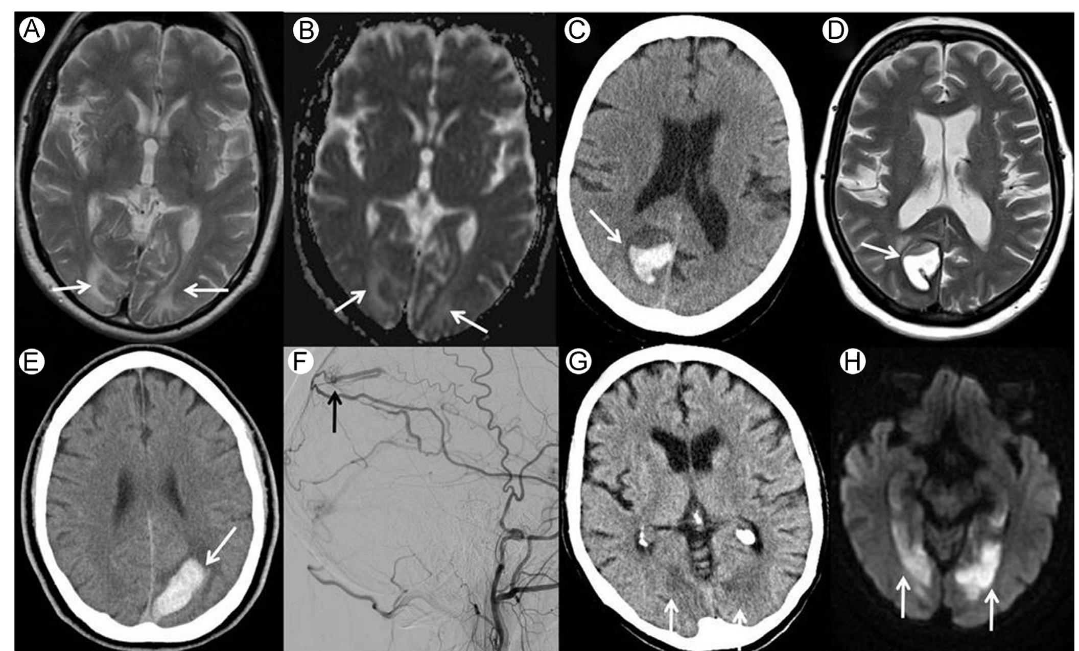 Occipital lobe lesions. (a) axial t2 and (b) adc map in a