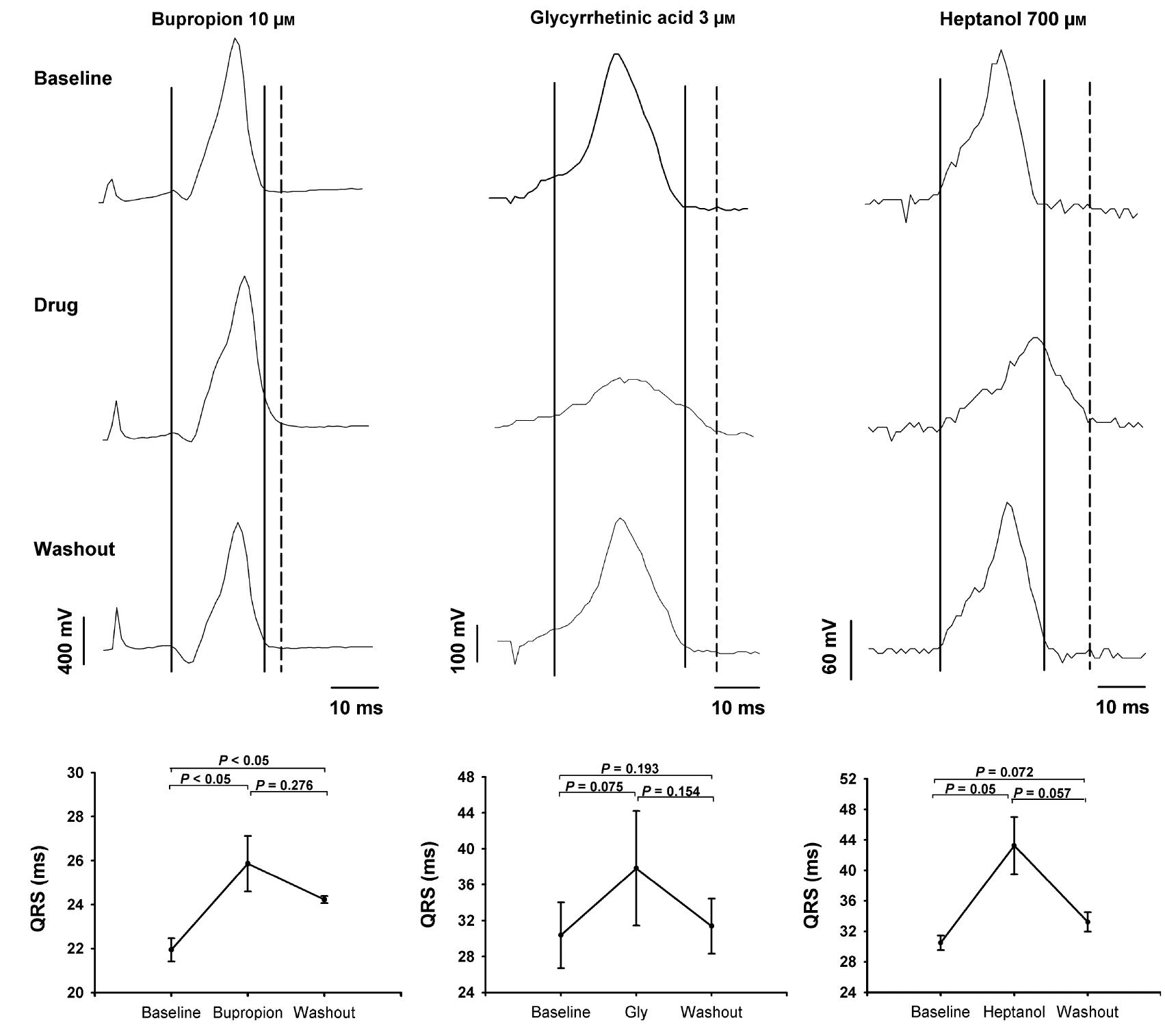Typical electrograms (mimicking lead ii ecg) from