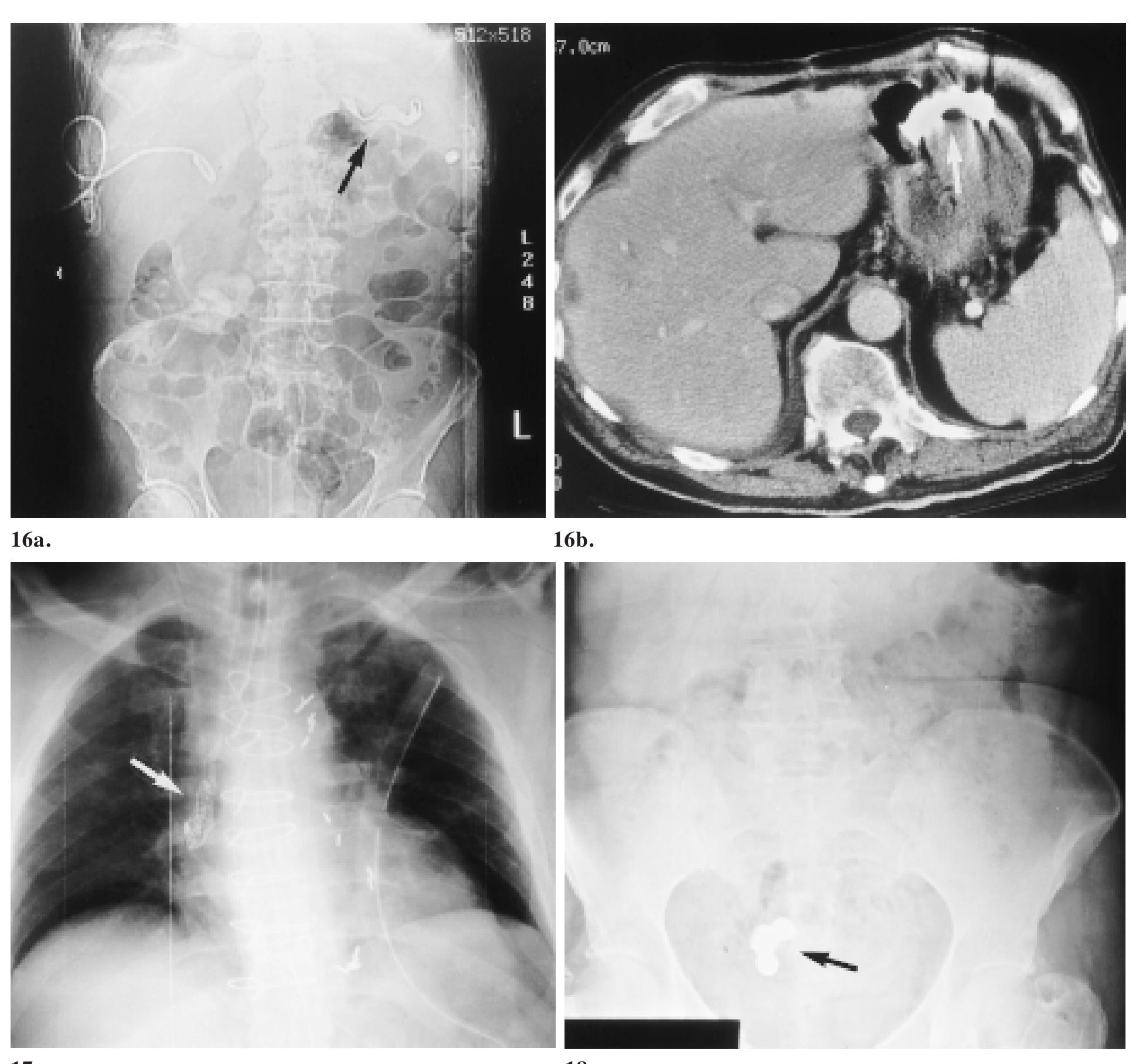 S 16-18. (16) radiopaque tail marker (arrow) of a retained