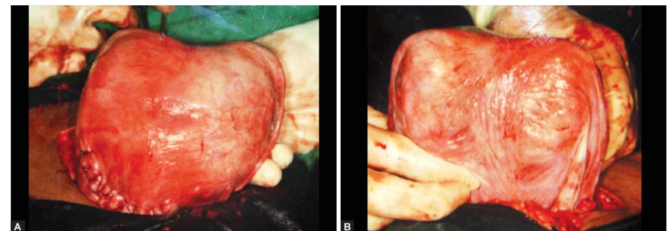 S 8a and b: septate uterus view from anterior and posterior