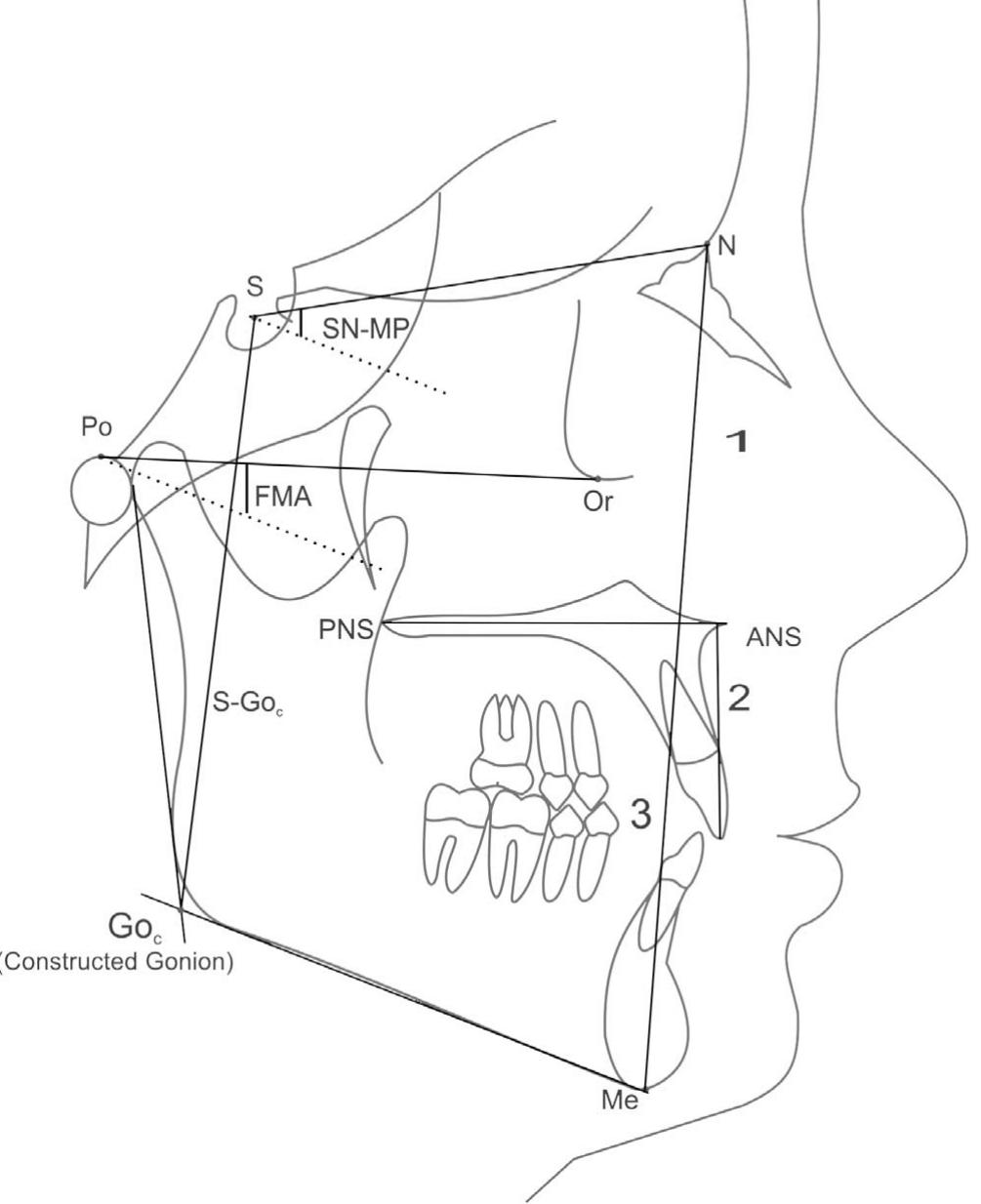 Parameters used to classify facial patterns, ie, sn-mp, fma,