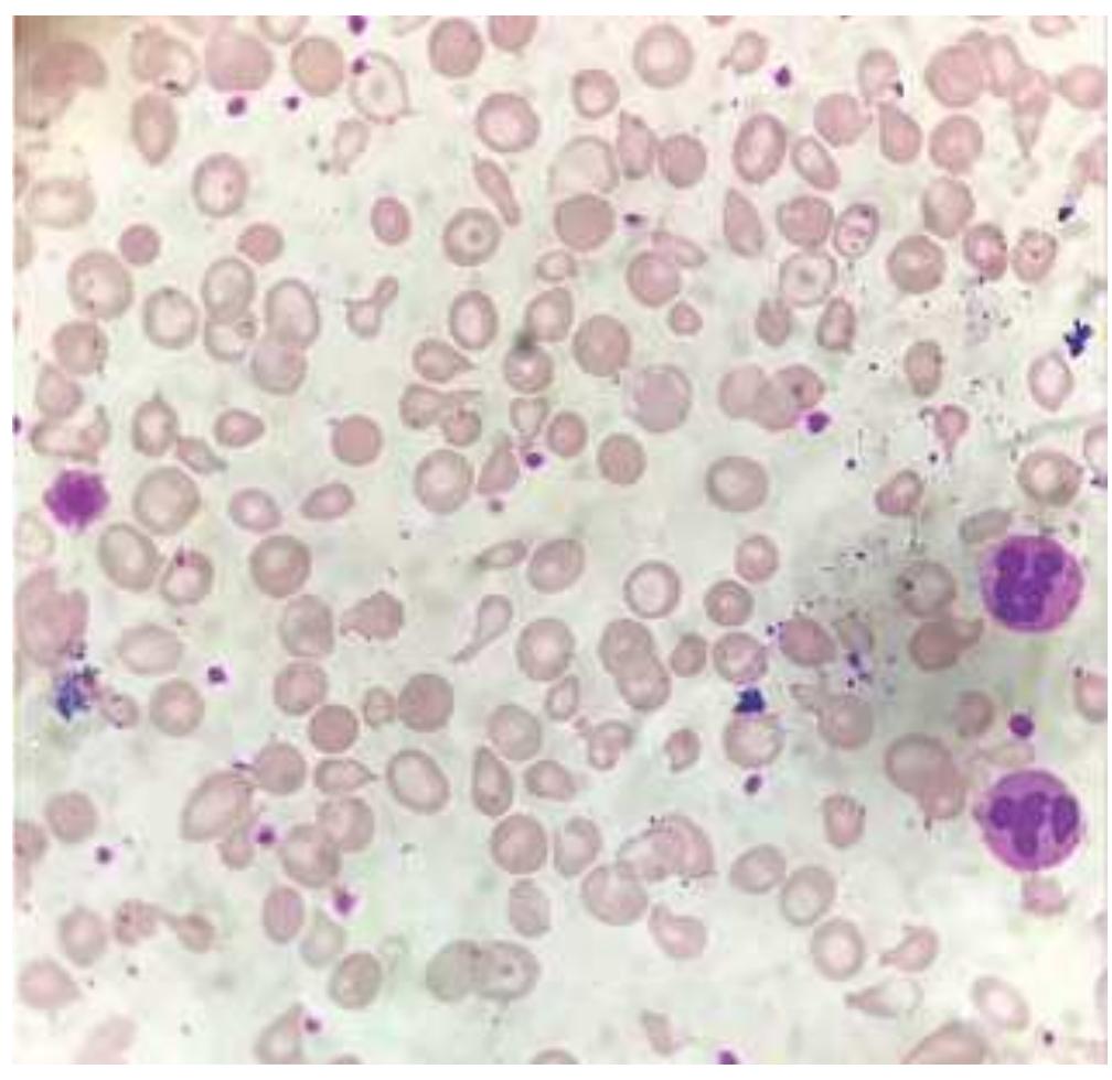 Most common anemia in our study on smear examination was