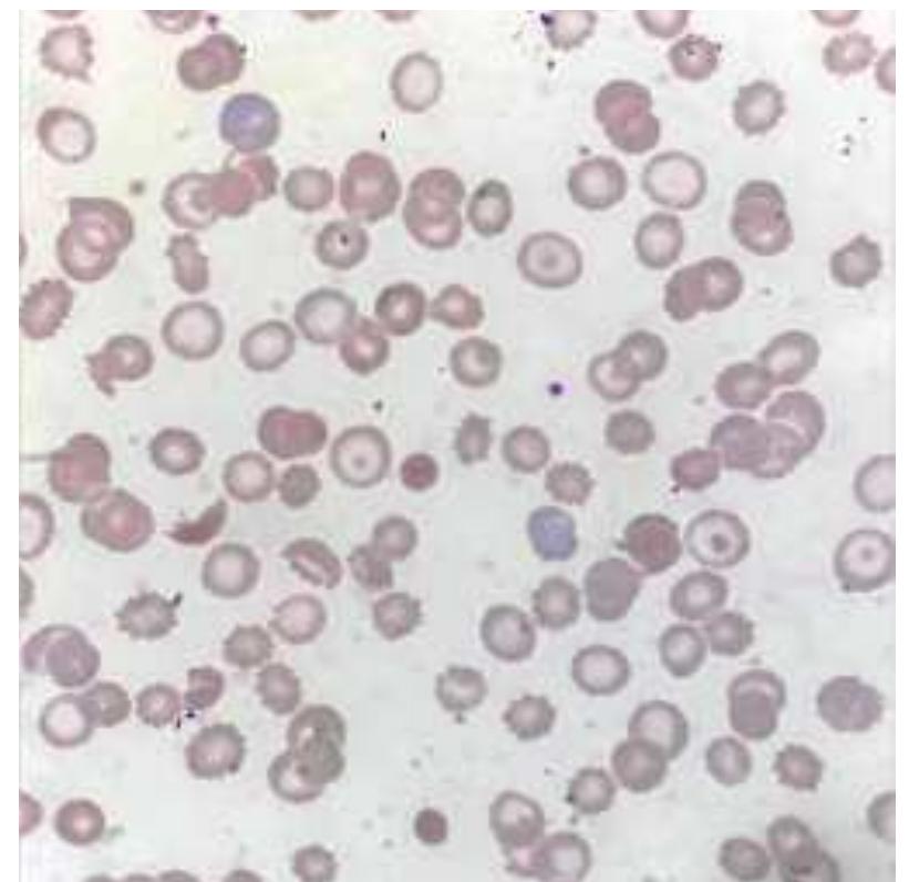 Peripheral blood smear of hemolytic anemia showing
