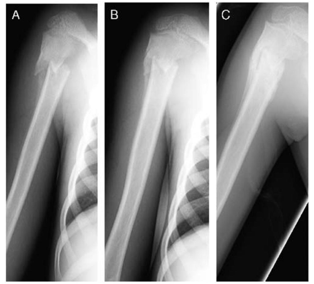 A young boy with proximal humerus fracture. a, fracture 10