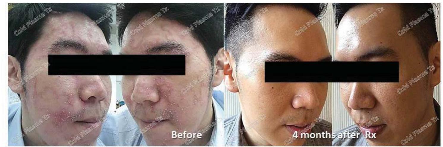 Clearance of tinea faciei with 4-month follow-up (treatment