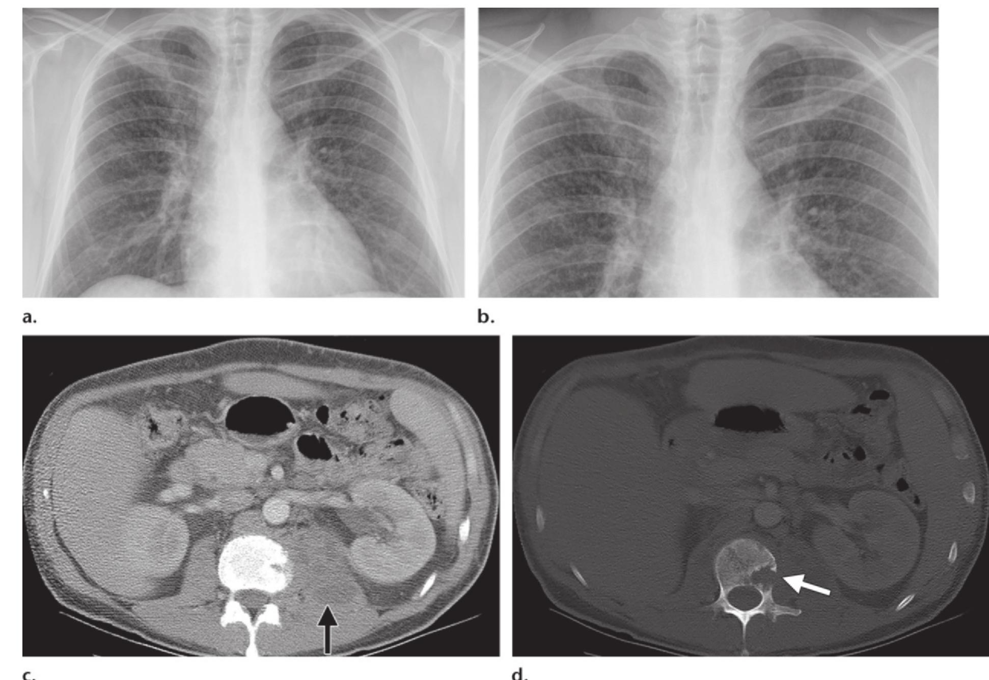 Disseminated pulmonary coccidioidomycosis with vertebral