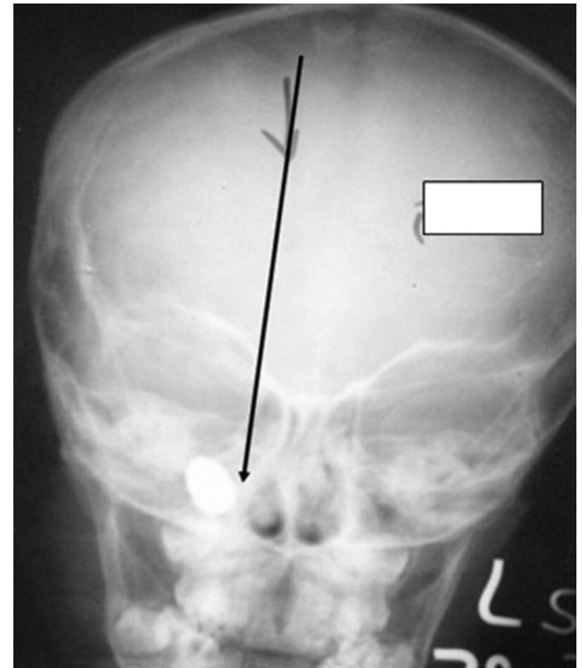 Posteroanterior skull radiograph showing profile route of