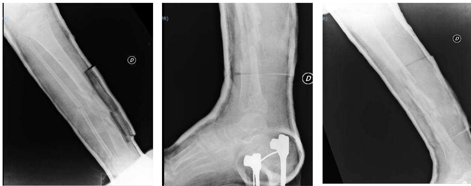 Radiograph of the right leg and ankle after the new
