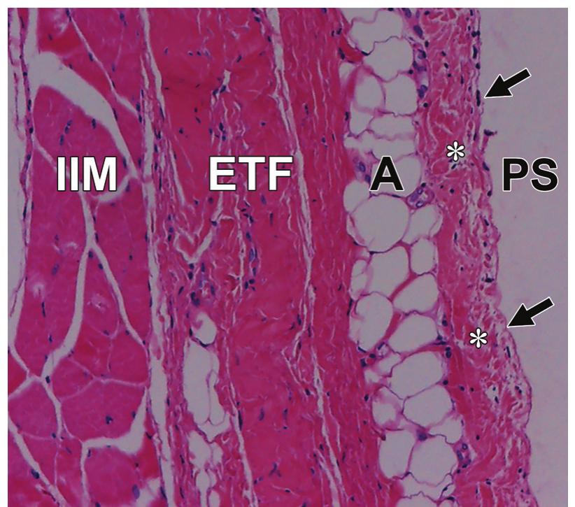 Photomicrograph of a pleural and chest wall biopsy tissue