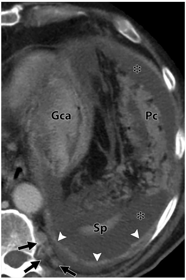 Lymphatic drainage of the posterior costal pleura. axial ct