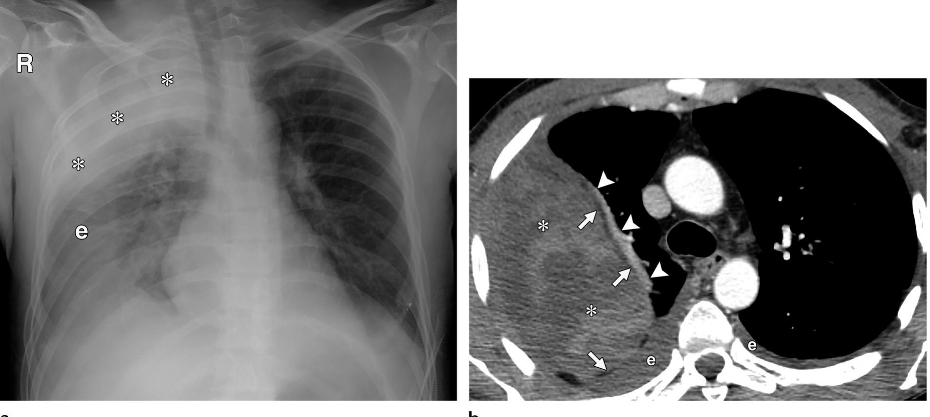 Extrapleural hematoma due to vascular injury to the