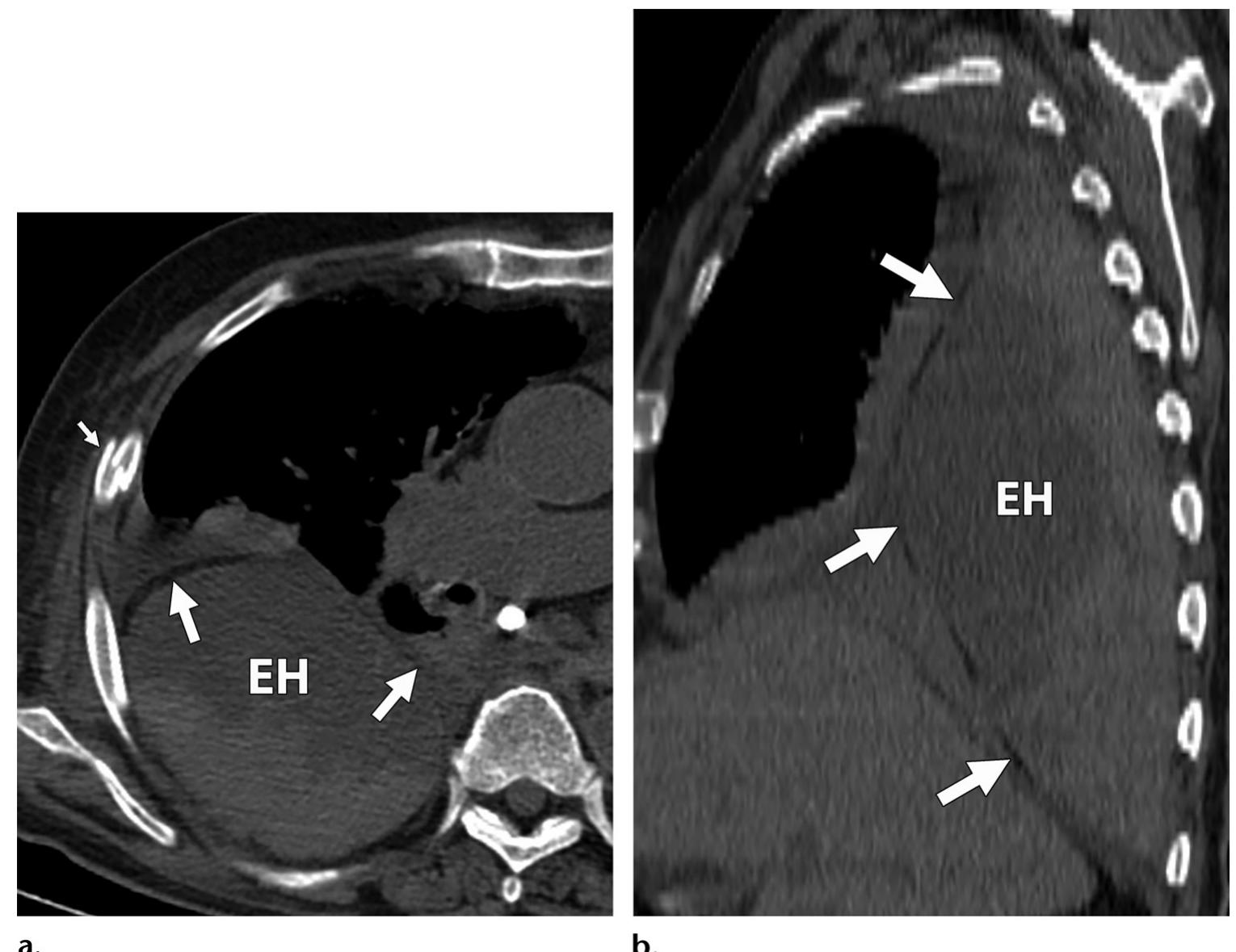 Extrapleura hematoma secondary to rib fracture. axial (a)