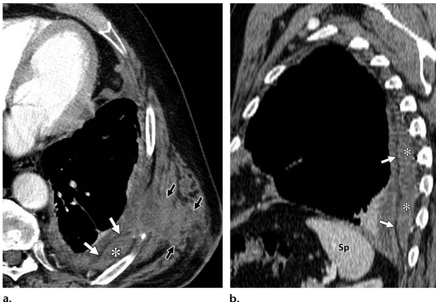 Extrapleural hematoma secondary to pleural biopsy to
